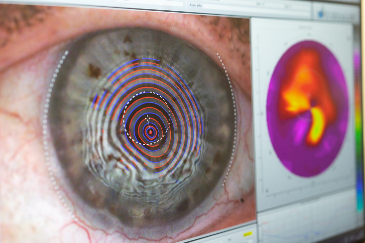 Staar - OMC Zaandam en Hoorn | Oogheelkundig Medisch Centrum